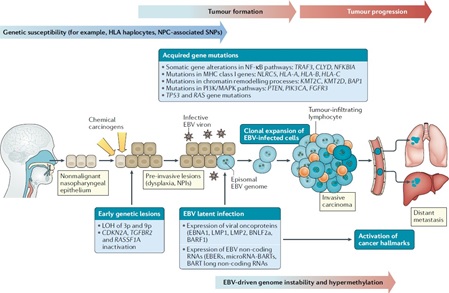Nasopharyngeal Carcinoma | ORLHNS