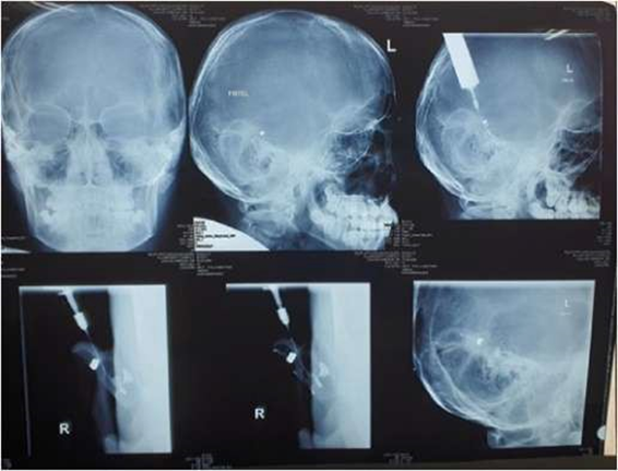 PREAURICULAR FISTULA | ORLHNS