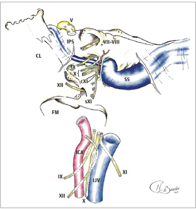 SYNDROME COLLET SICARD AS COMPLICATIONS FROM MALIGNANT OTITIS EXTERNA ...